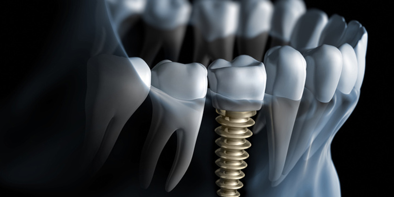 Dental Implants | Intelligent Touch Dental Laboratory | Woodbury, MN