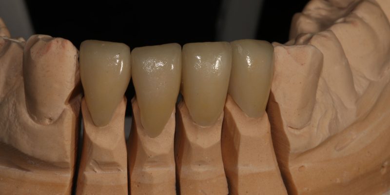 Digital Dental Lab | Intelligent Touch Dental Lab | Woodbury, MN